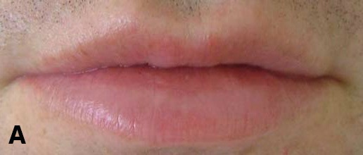 Skin Cancer Lower Lip Photos